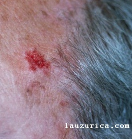 Queratosis seborreica y signo de Leser-Trélat | Cuaderno en piel