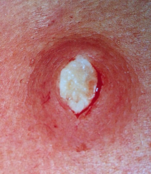 ¿Quiste sebáceo sin grasa?…Mejor, quiste epidérmico. | Cuaderno en piel