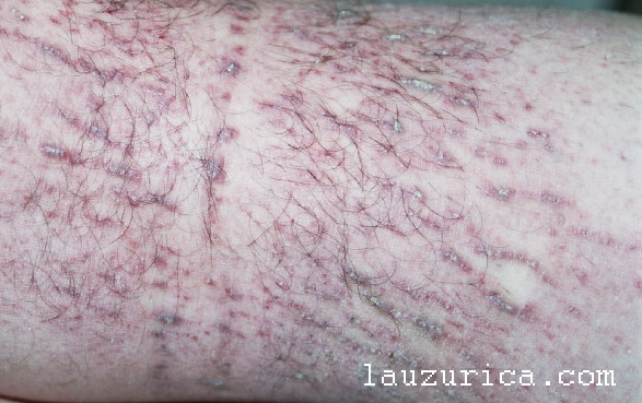Queratosis Liquenoide Crónica lesiones lineales Dr. Lauzurica ...