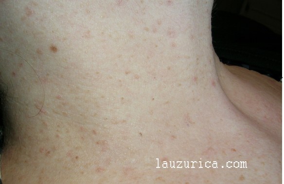 Esto Es Lo Que Significa Tener Verrugas En El Cuello Verrugas Víricas
