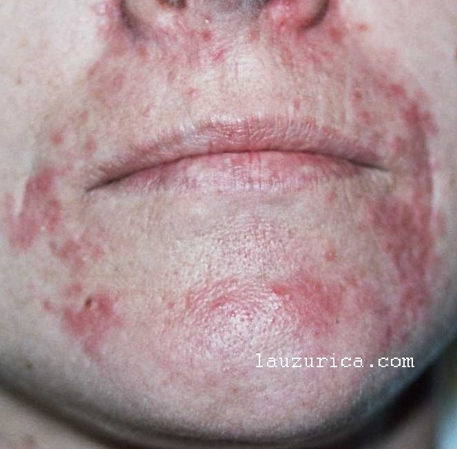 Dermatitis perioral | Cuaderno en piel