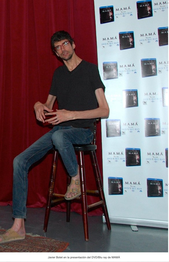 Sindrome De Javier Botet Marfan