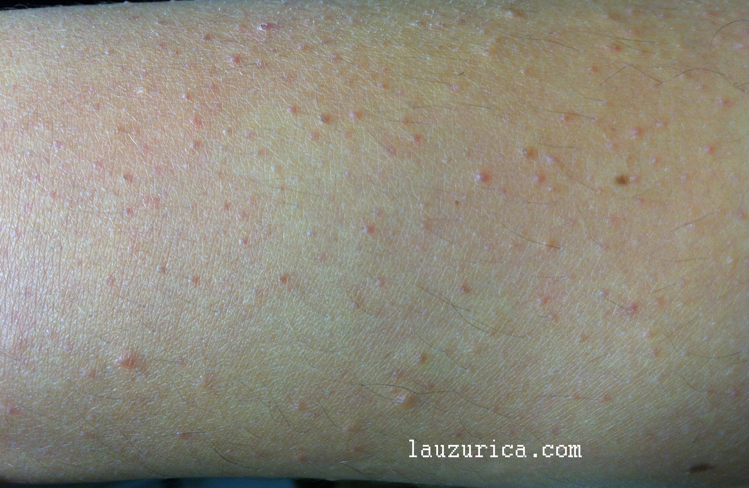 Queratosis folicular | Cuaderno en piel