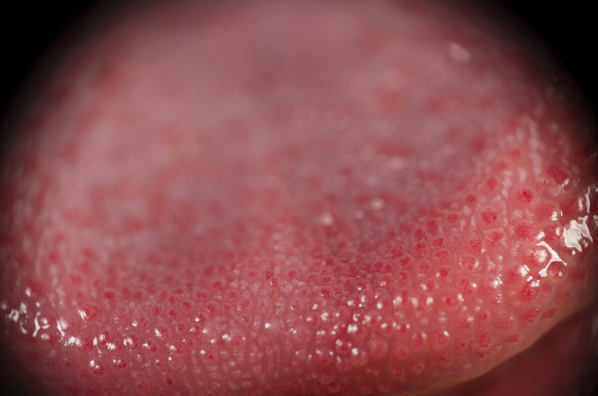 Lengua irritada por déficit de hierro; relación con piel, uñas y pelo ...