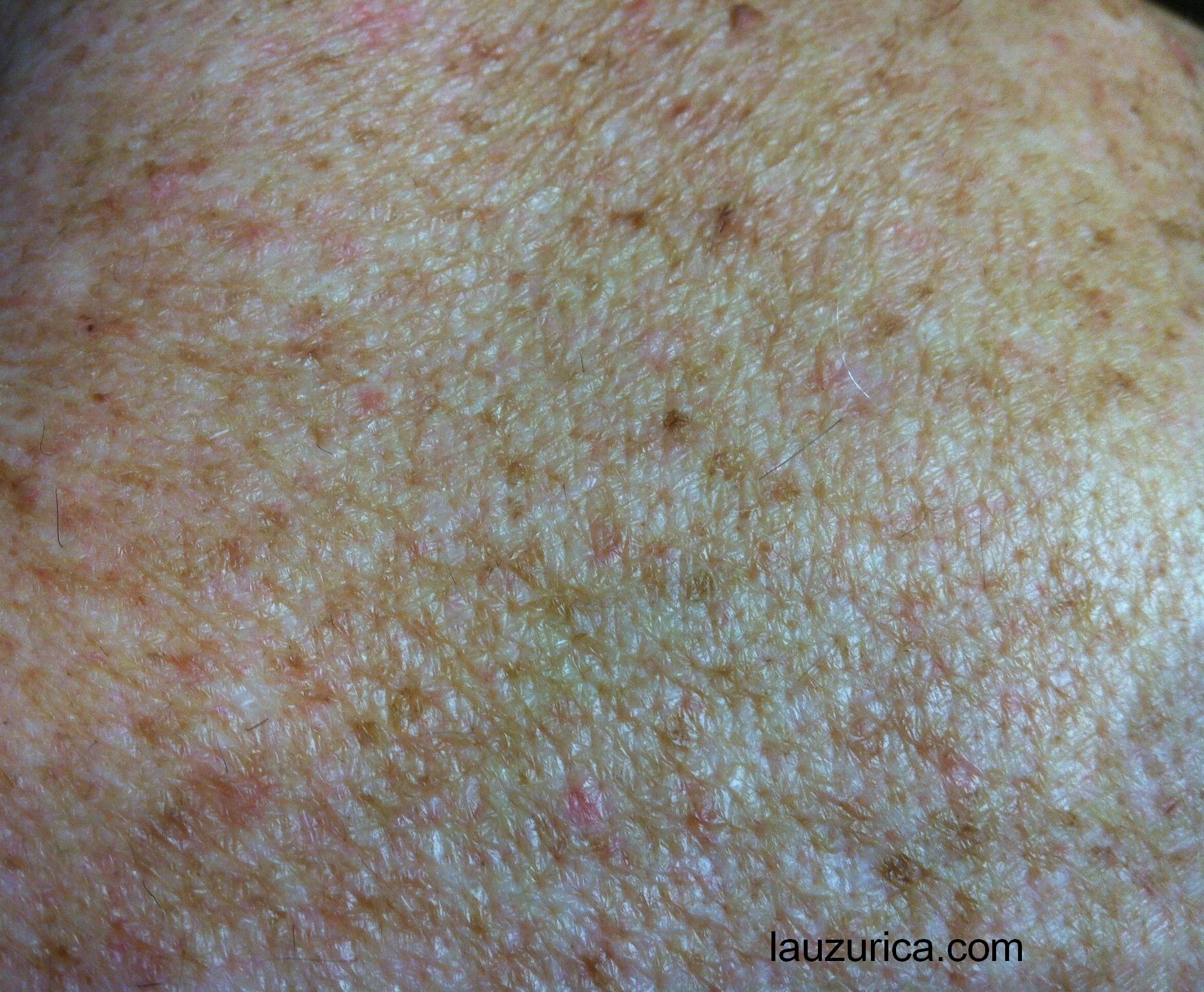 Retinoides tópicos | Cuaderno en piel