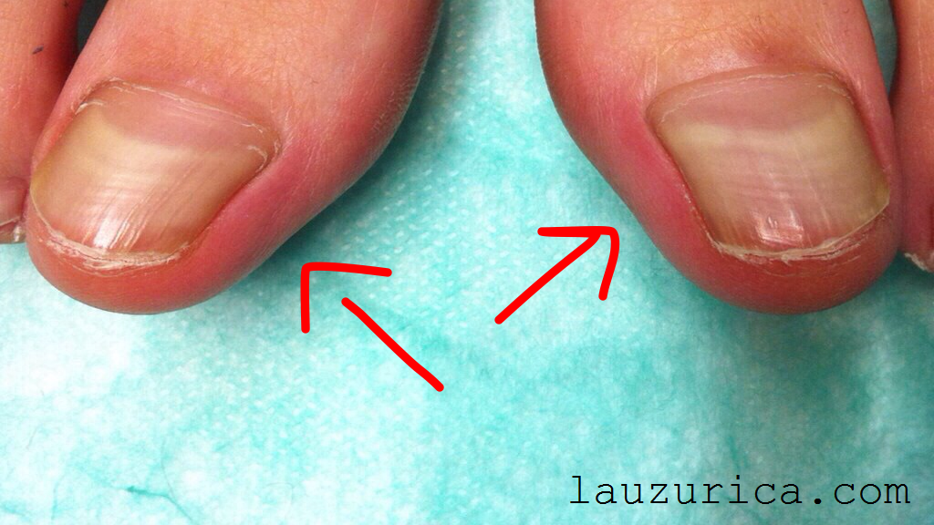 Uñas de pies alteradas (onicodistrofia), no es sinónimo de hongos ...