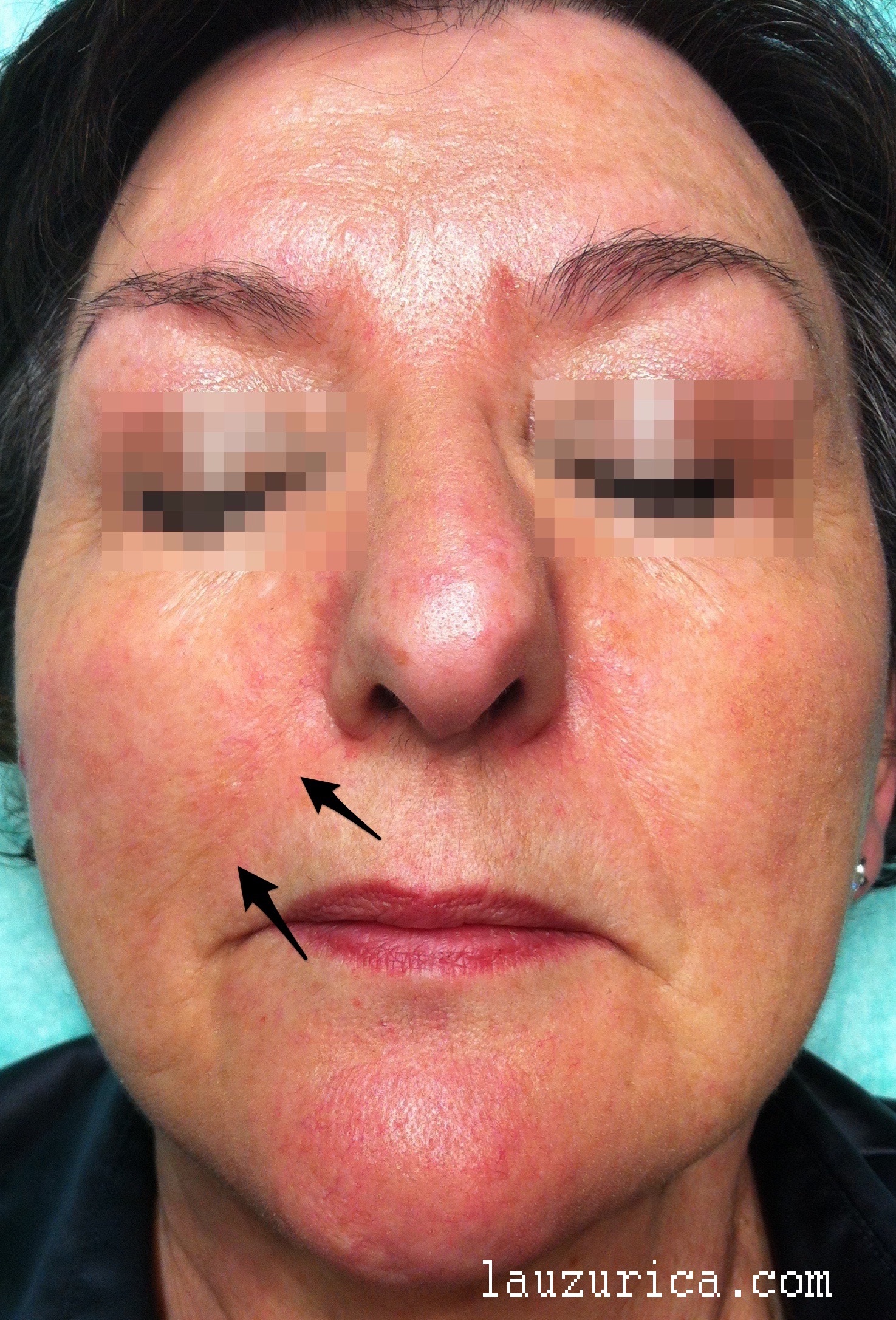 Morfea profunda en la cara | Cuaderno en piel