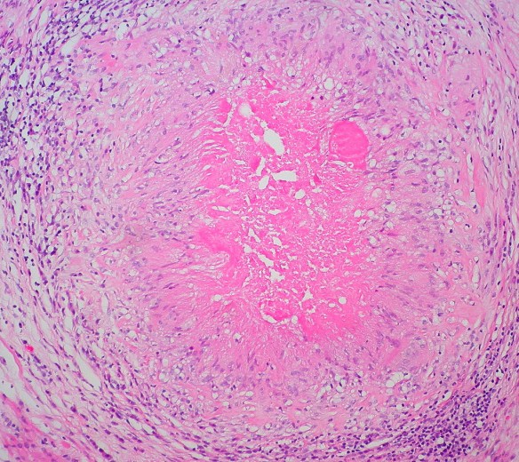 Histologia Do Granuloma Anular