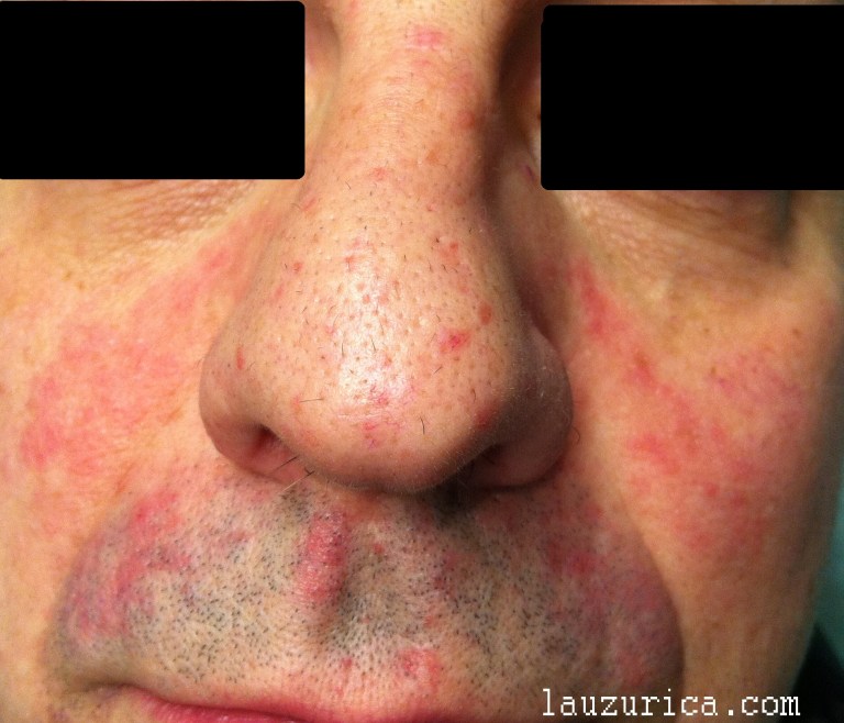 Dermatitis Seborreica: picor, rojez y descamación en la cara | Cuaderno ...