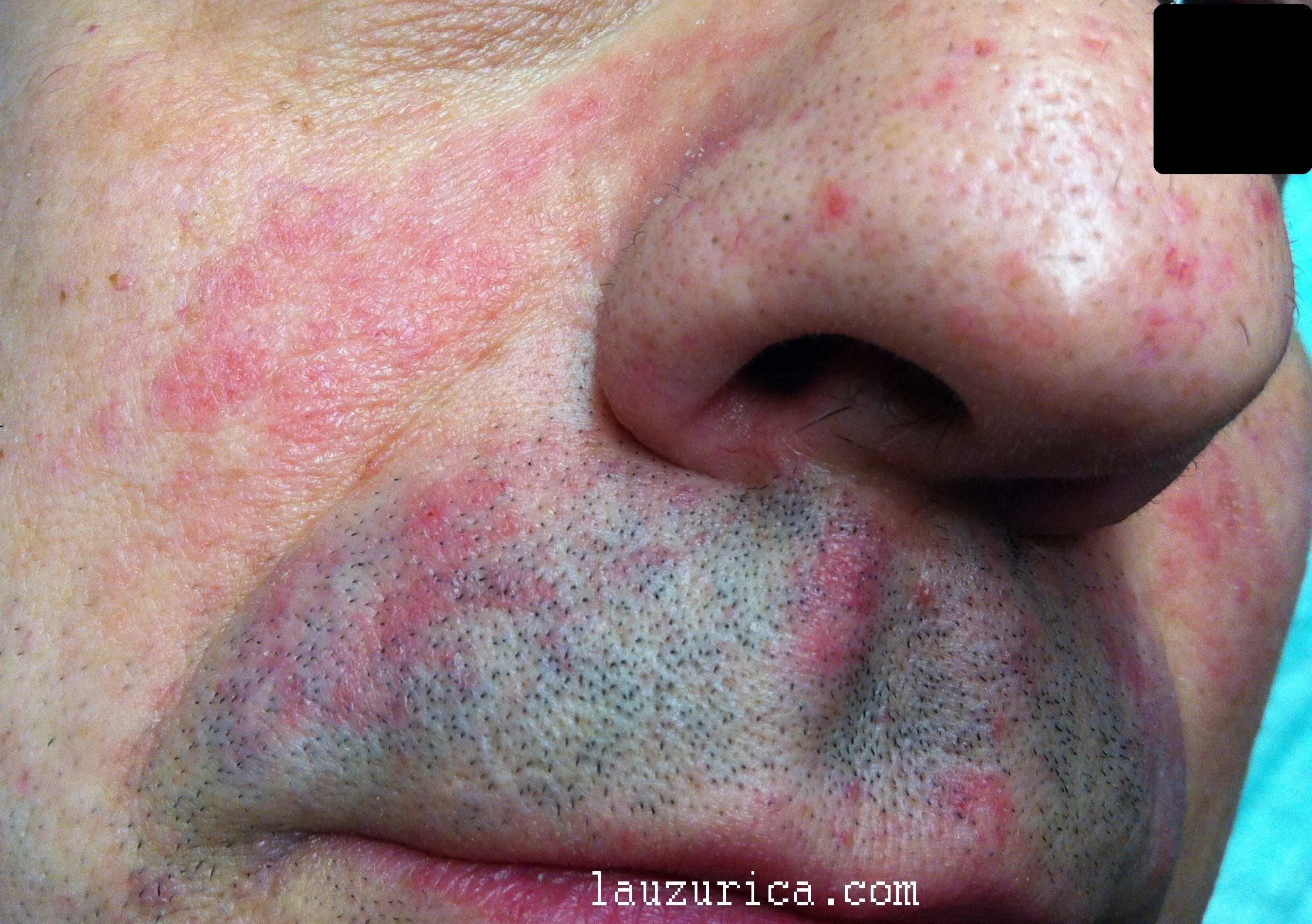 Dermatitis Seborreica: picor, rojez y descamación en la cara | Cuaderno ...