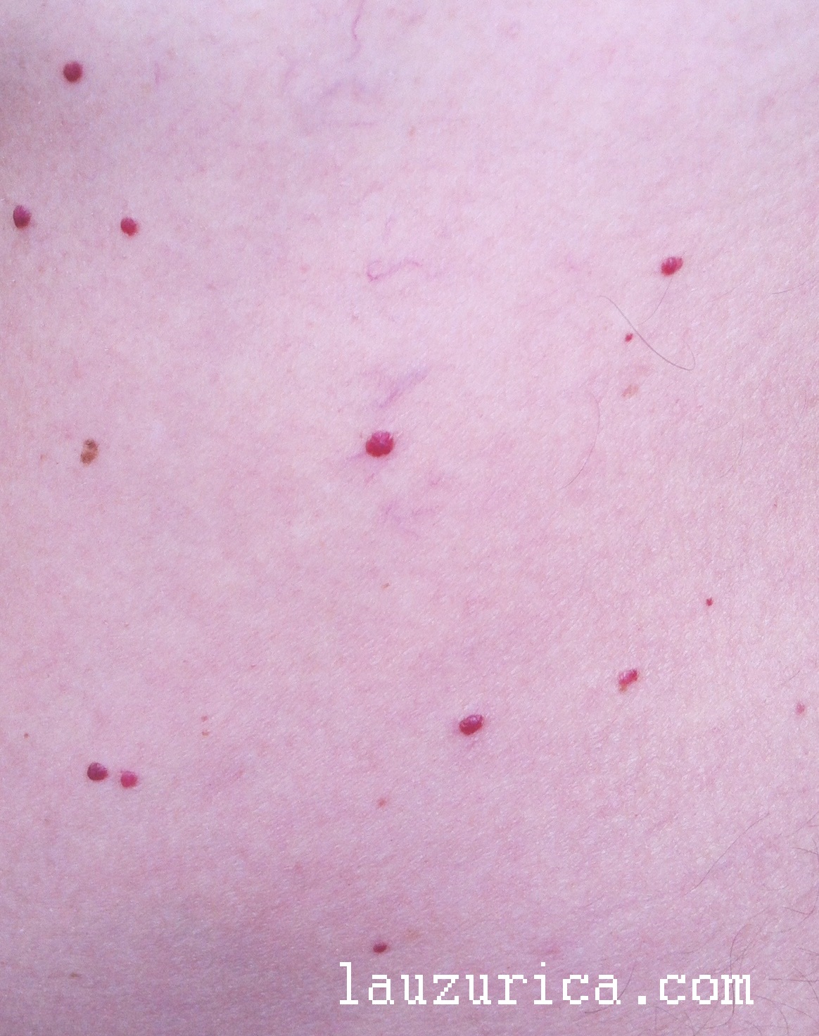 Puntos Rojos En La Piel Qué Son Los Puntos Rojos En La Piel Y Por