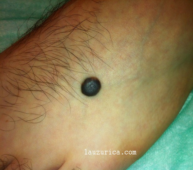 Nevus azul | Cuaderno en piel