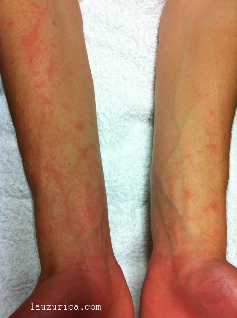 Dermatitis de los prados, una fitofotodermatitis | Cuaderno en piel