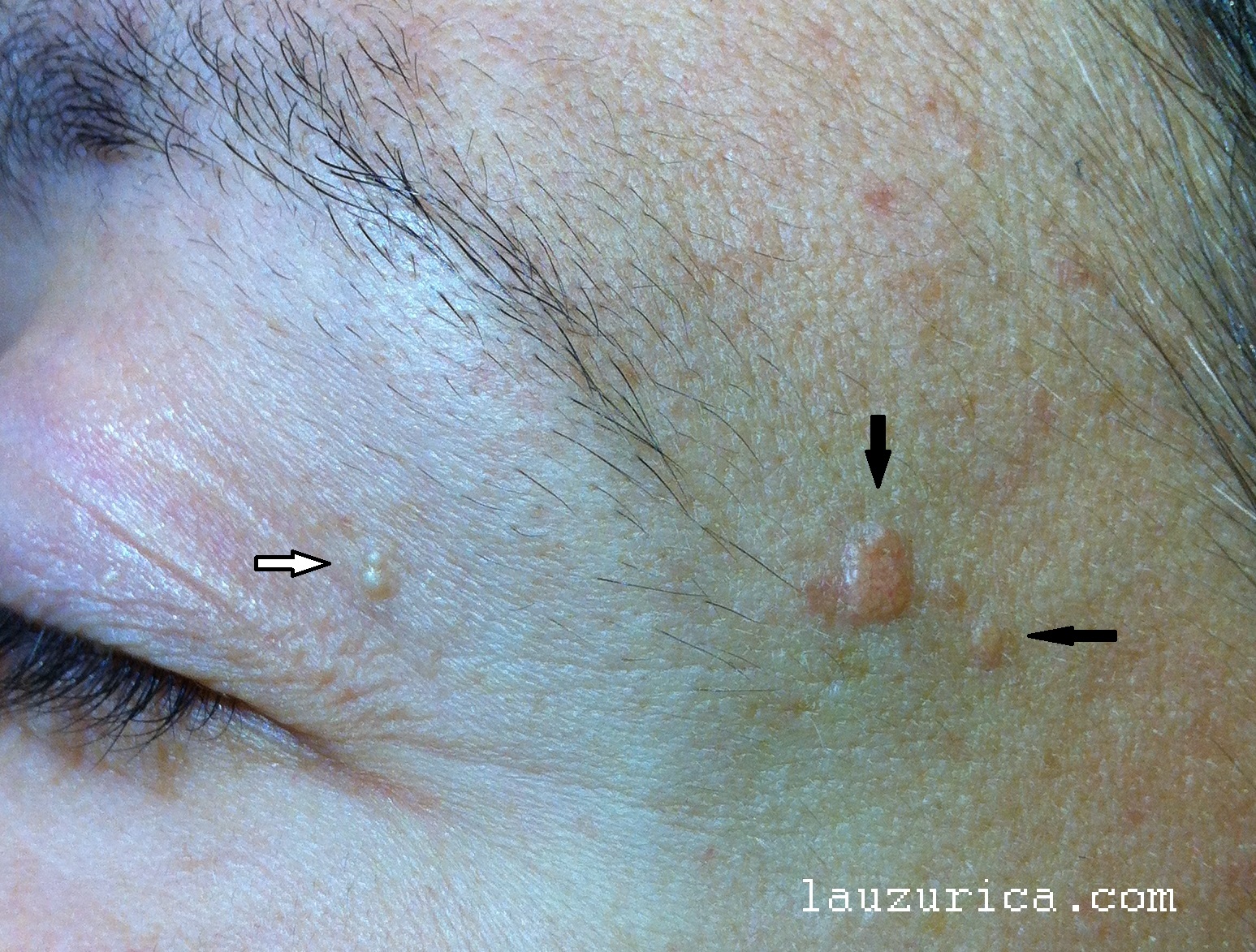 quiste de milium | Cuaderno en piel