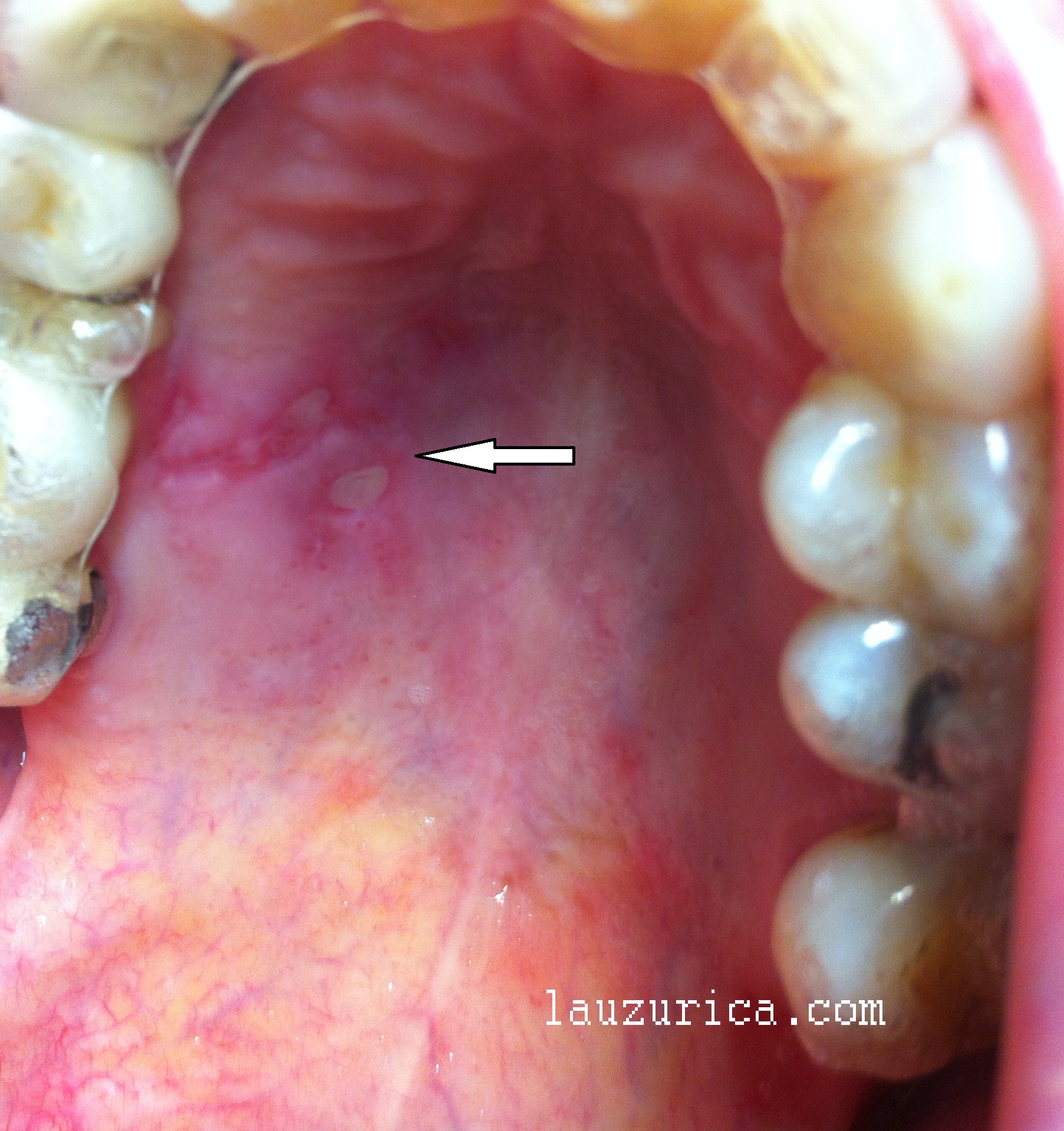 Aftas orales…llagas en la boca | Cuaderno en piel