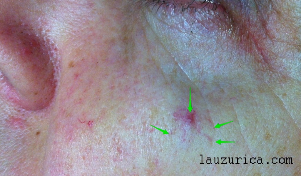 Araña vascular, nevus aracneus, spider nevus | Cuaderno en piel