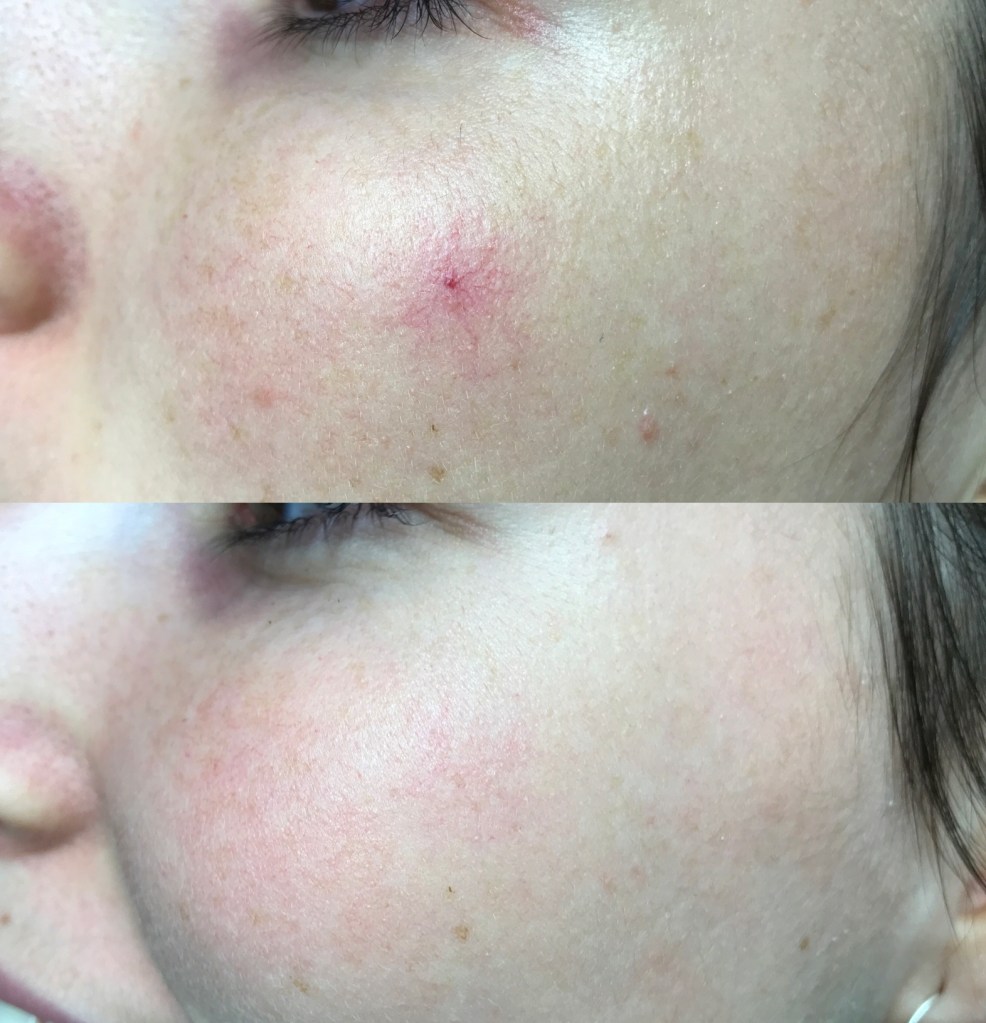 Araña vascular, nevus aracneus, spider nevus | Cuaderno en piel