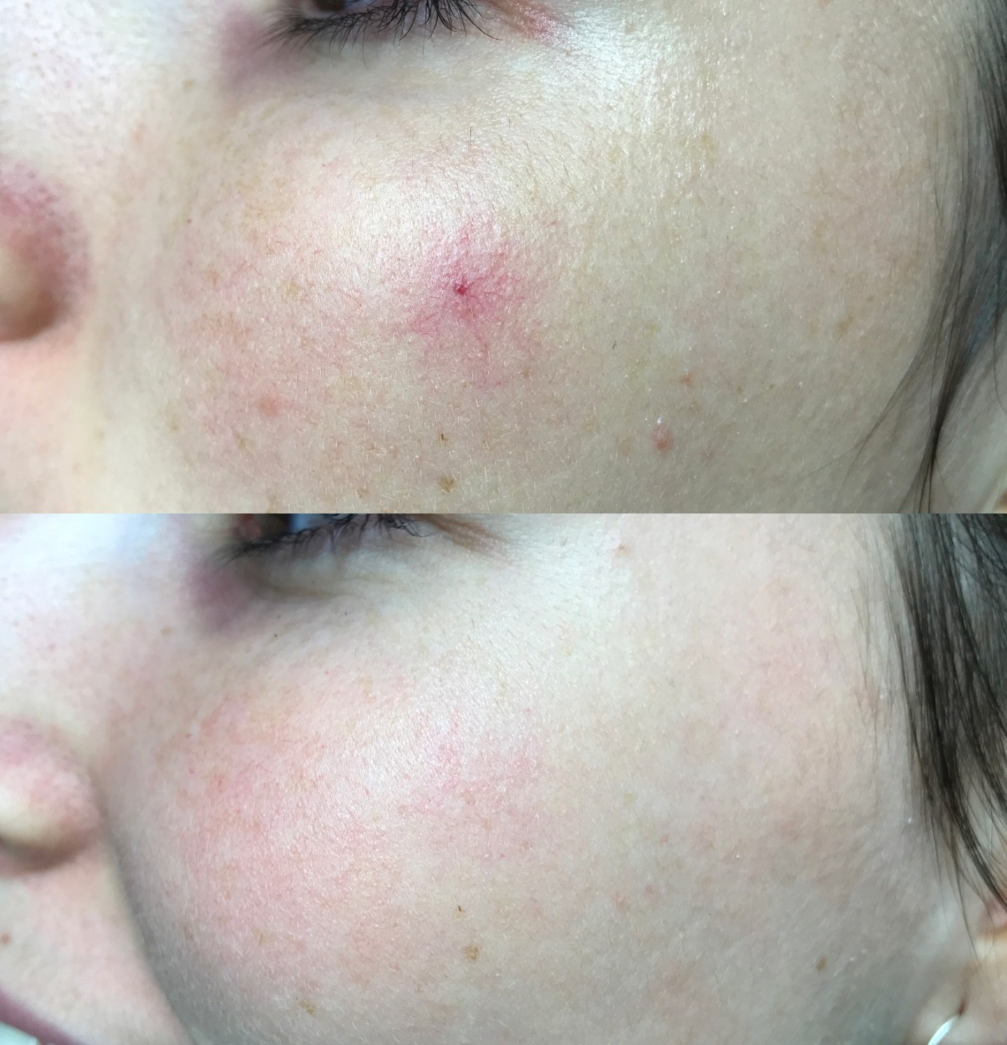 Araña vascular, nevus aracneus, spider nevus | Cuaderno en piel