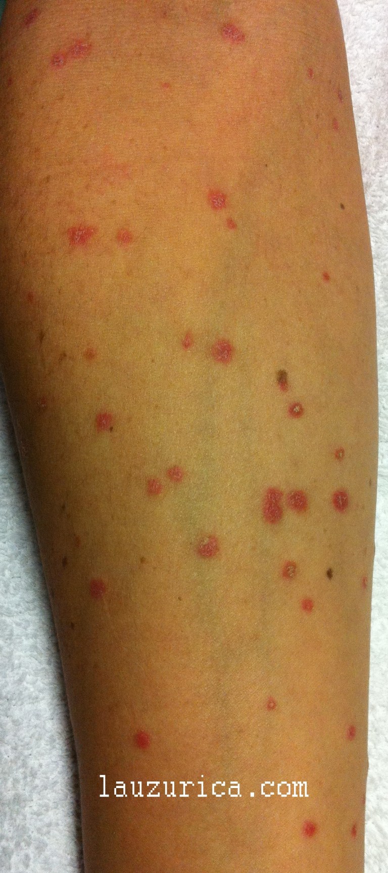 Psoriasis guttata o psoriasis en gotas | Cuaderno en piel