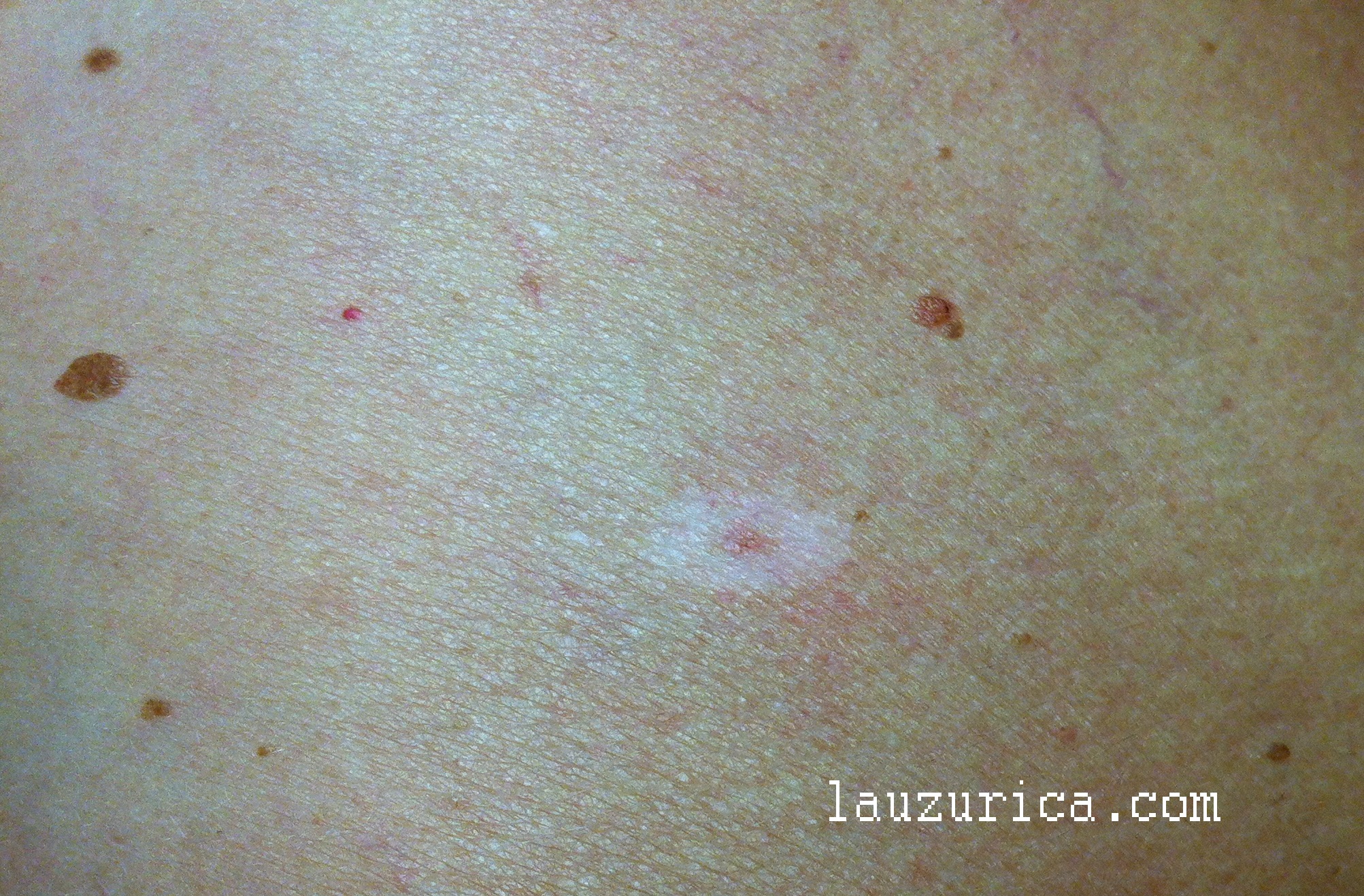 Halo nevus, una pérdida de pigmento muy caprichosa. Nevus de Sutton en ...